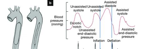Intra Aortic Balloon Pump A The Balloon Is Shown In Its Inflated And