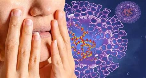 სან ფრანცისკოში „მაიმუნის ყვავილის“ შემთხვევების მატების გამო საგანგებო მდგომარეობა გამოცხადდა Bpn