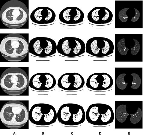 Segmentation Of Lung Parenchyma In Thoracic Ct Image Using Optimization