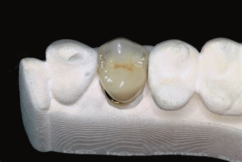 What Is Feldspathic Porcelain Mindfulness Life