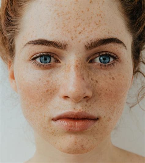 How To Get Rid Of Freckles Without Makeup Saubhaya Makeup
