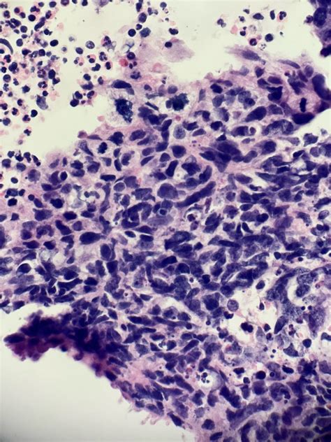 Pelvic Washing 62yr Female Cytology Slides Show Positive For Malignancy