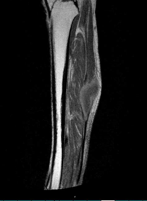 Pdf Idiopathic Pyoderma Gangrenosum Successful Resolution With Infliximab Therapy And Pro