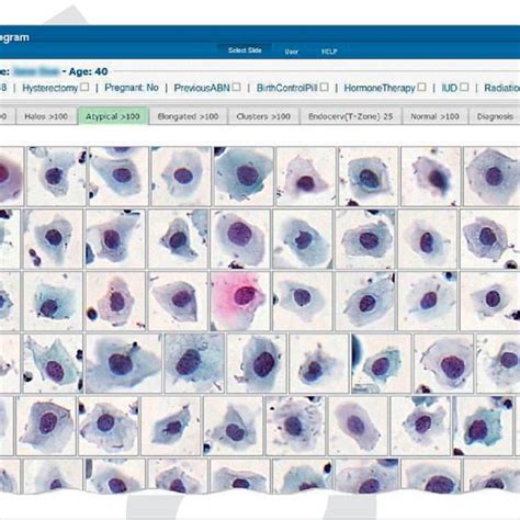 Thinprep Manual Versus Bestprep Manual Hsil Is Truth For The Cases Download Table