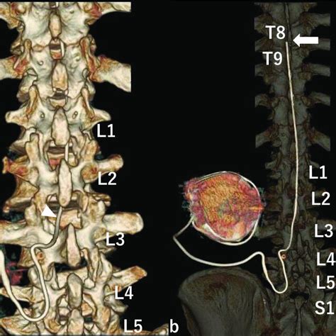 Intrathecal Baclofen Itb Pump Implantation Itb Pump Implantation Was