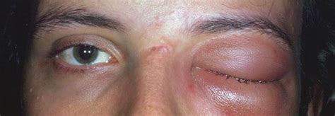 Periorbital Swelling Conjunctivitis