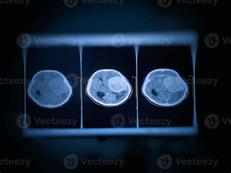 Ct Brain Diameter Hyperdensity Mass With Lobulated Surface At Extra