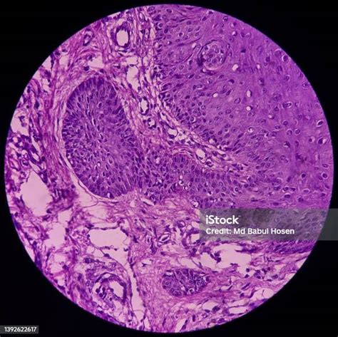 Verrucae 또는 턱 피부 사마귀의 현미경 사진 현미경은 각화증과 유두종증이있는 표피 과형성증을 보여줍니다 과다형성에 대한 스톡 사진 및 기타 이미지 Istock