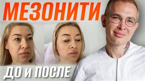 МЕЗОНИТИ ДО и ПОСЛЕ | Ставим Нити COG, мгновенная подтяжка лица # ...