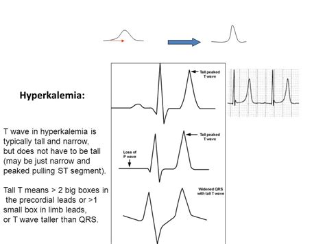 Electrolyte Abnormalities And Ecg Ppt Video Online Download