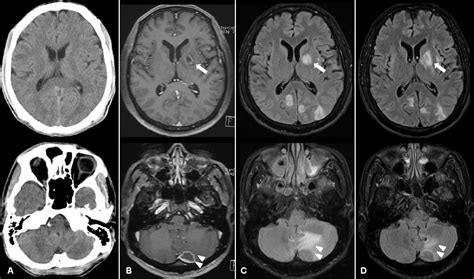 Figure 2 From Toxoplasma Encephalitis In A Patient With Human Immunodeficiency Virus Infection
