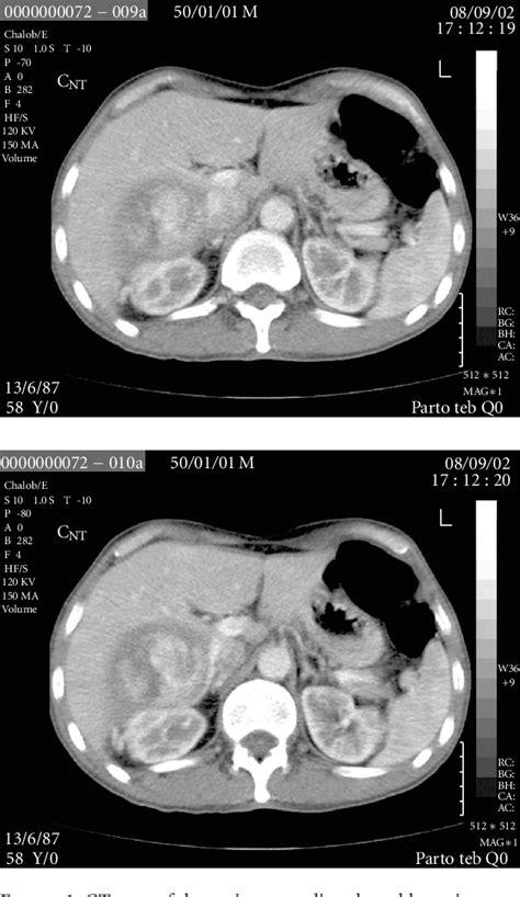 Figure 1 From Renal Cell Carcinoma Mimicking Adrenal Tumor Semantic Scholar