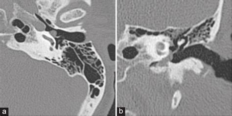 Imaging In Pulsatile Tinnitus Case Based Review Journal Of Clinical