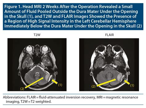 Auditory Hallucinations After Microvascular Decompression For Intractable Trigeminal Neuralgia