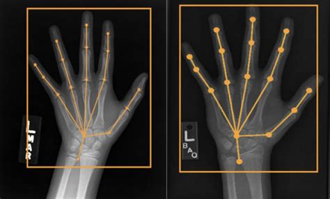 Hand Pose Estimation For Pediatric Bone Age Assessment Biomedical Computer Vision