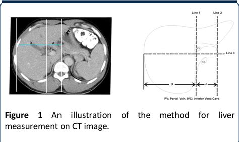 Figure 1 From Computed Tomography Evaluation Of The Caudate To Right