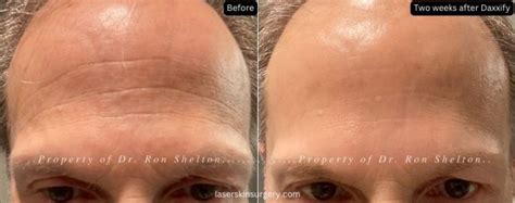 Nyc Daxxify Before And After Ron Shelton M D Patient Photos