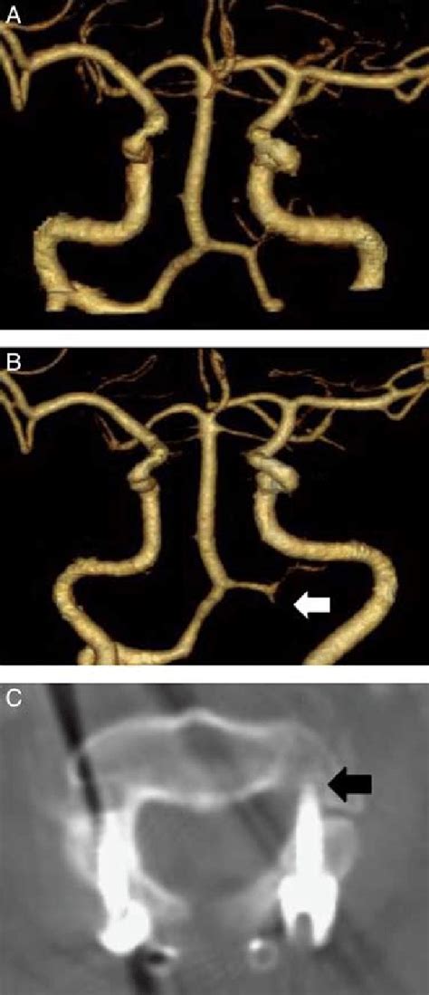 Iatrogenic Vertebral Artery Stenosis Caused By Vertebral Canal Download Scientific Diagram