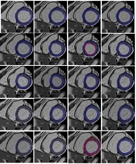 Segmentation Of The Left Ventricle Download Scientific Diagram