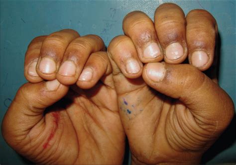 Nail Tic Disorders Manifestations Pathogenesis And Management