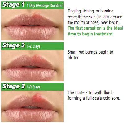 Beginning Of Cold Sore Stages