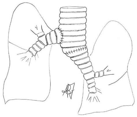 Technical Options In Carinal Resection And Reconstruction Ctsnet