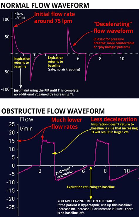 Ventilator Waveform Anatomy The Basics You Gotta Know