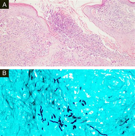 A Histopathology Of The Surgical Specimen Of The First Patient Shows Download Scientific