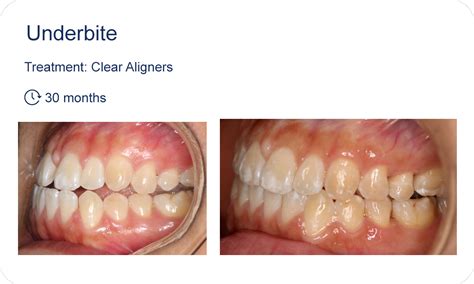 Clear Aligners Invisalign And Spark Aligners Ortho Co