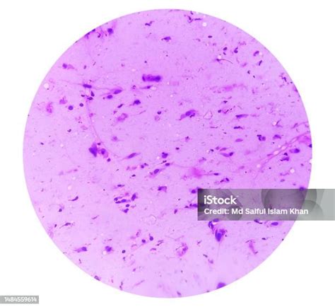 Photomicrograph Showing Neurofibroma Neurofibromatosis Is A Genetic