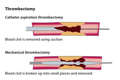 Thrombectomy Cirse