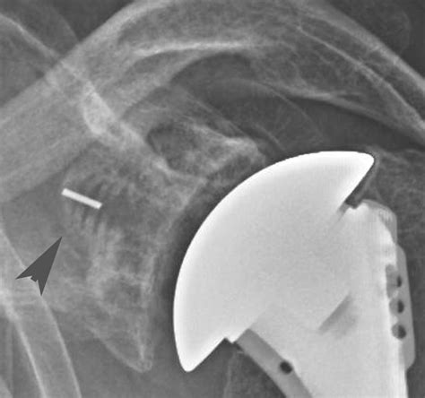 Uw Shoulder And Elbow Academy Total Shoulder Arthroplasty Selecting The Glenoid Component