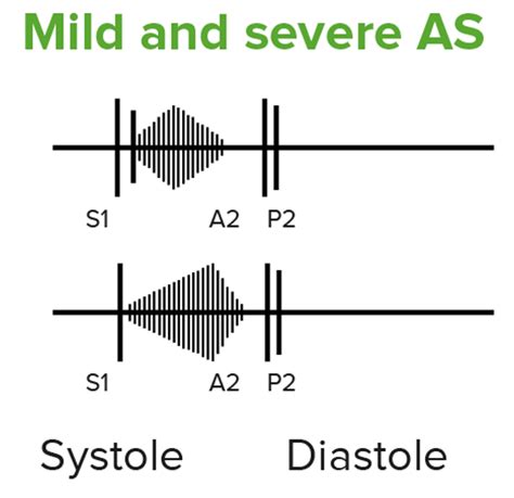 Heart Sounds Concise Medical Knowledge