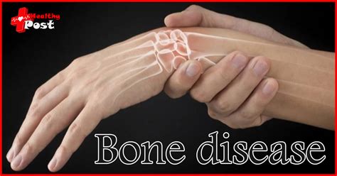 How Much Do You Know About Bone Disease