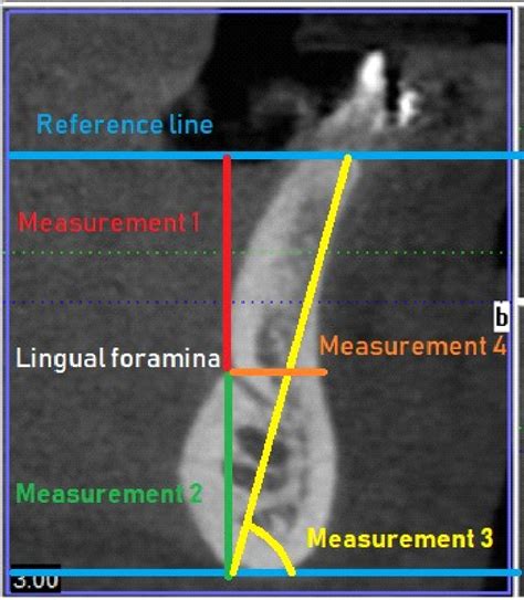 [pdf] Position Of Lingual Foramina In Cone Beam Computed Tomography And Its Implications For