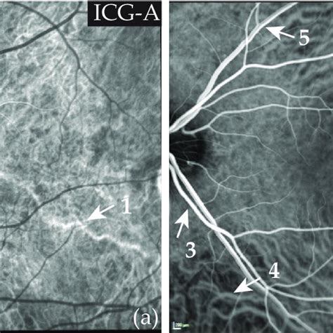 Pdf Choroidal Vasculature Imaging With Laser Doppler Holography