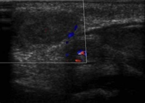 Ultrasound Image Of The Left Part Of The Interior Inguinal Canal