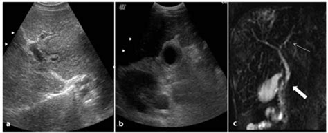 Cholangitis Radiology Key