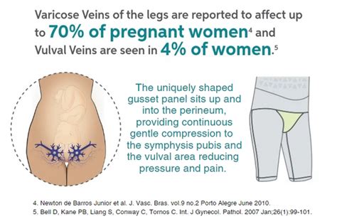 Vulvar Varices How To Treat Vaginal Varicose Veins