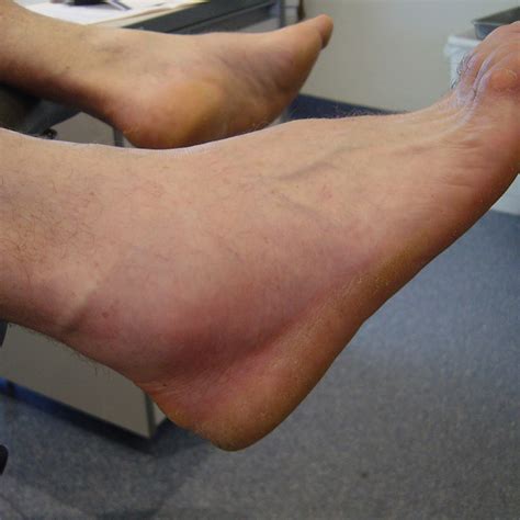 Tendonitis What Are Your Treatment Options Foot And Ankle