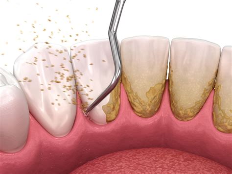 Quais As Causas Do Tártaro Prime Sorriso Odontologia