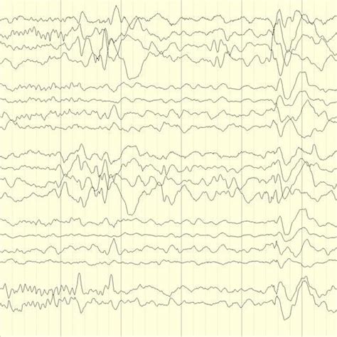 Visual Inspection Of Spikes A Epileptic Spikes In The Base Rhythm B