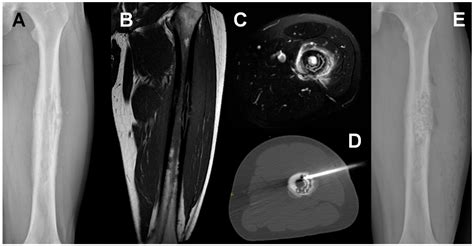 Osteomyelitis Mri