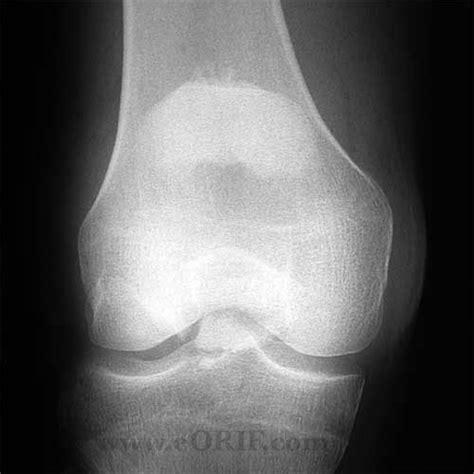 Patella Fracture S A EORIF
