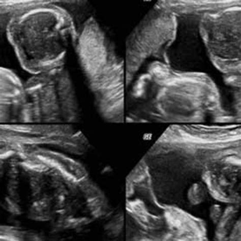📃 Caudal Regression Syndrome