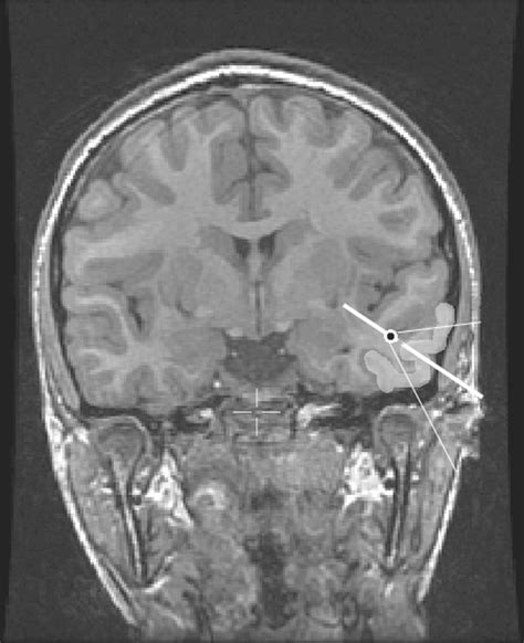 Eeg Voltage Topography And Dipole Source Modeling Of Epileptiform