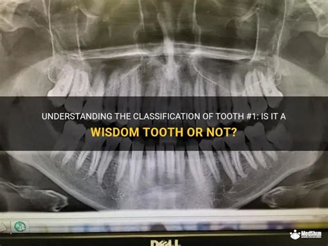 Understanding The Classification Of Tooth 1 Is It A Wisdom Tooth Or Not Medshun