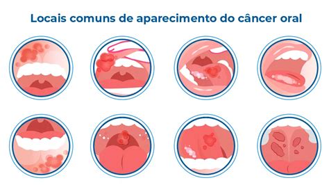 Câncer Oral Sintomas Causas E Tratamentos