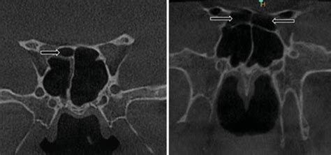 Onodi Cell Ct Scan