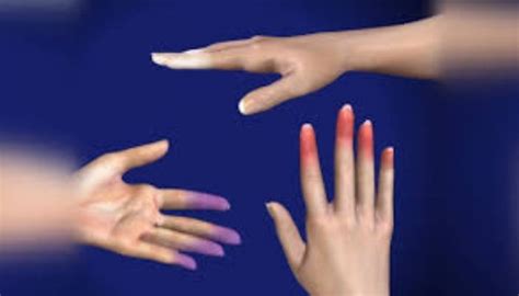 Botox And Raynaud S Scleroderma Queensland